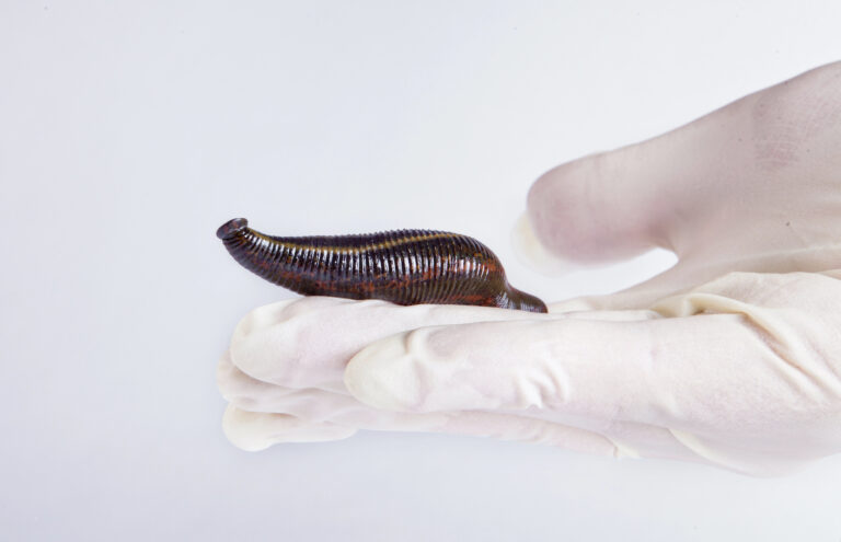 Leeches for rheumatic diseases. How can leech therapy help with joint ...